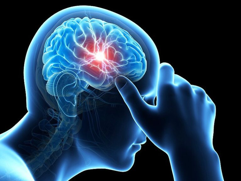 What is a concussion? - Onondaga Physical Therapy