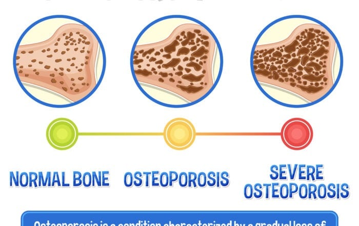 What is the Meeks Method? - Onondaga Physical Therapy